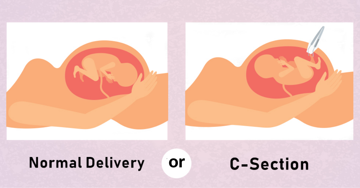 Normal Delivery vs C-Section: Which is Better?